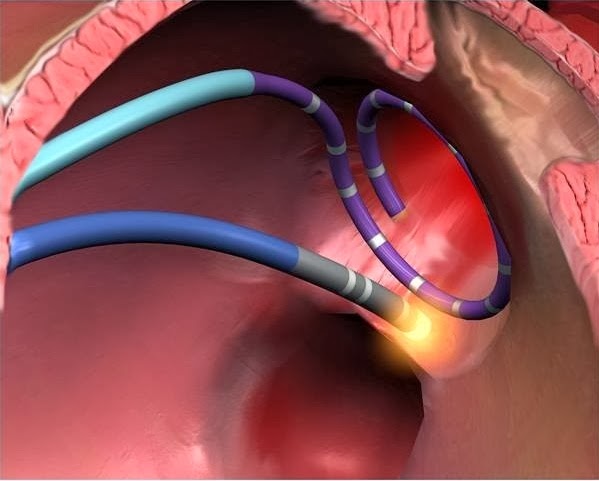 Aritmologia e Ablazioni transcatetere - Dr Enrico Mura Aritmologia e Ablazioni transcatetere - Dr Enrico Mura