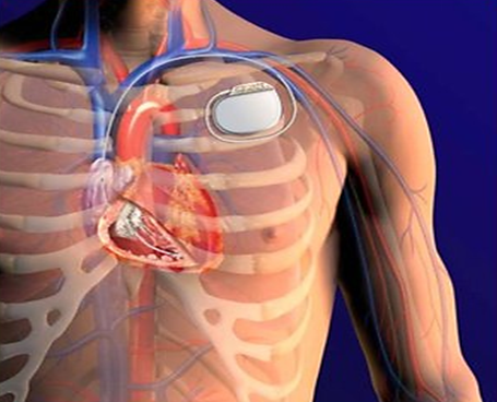 Impianto di Pacemaker - Dr. Enrico Mura